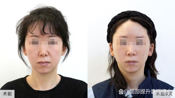 拉皮手术多久恢复自然_拉皮手术恢复期多久-第2张图片-山城妙识 拉皮手术多久恢复自然_拉皮手术恢复期多久-第2张图片-山城妙识