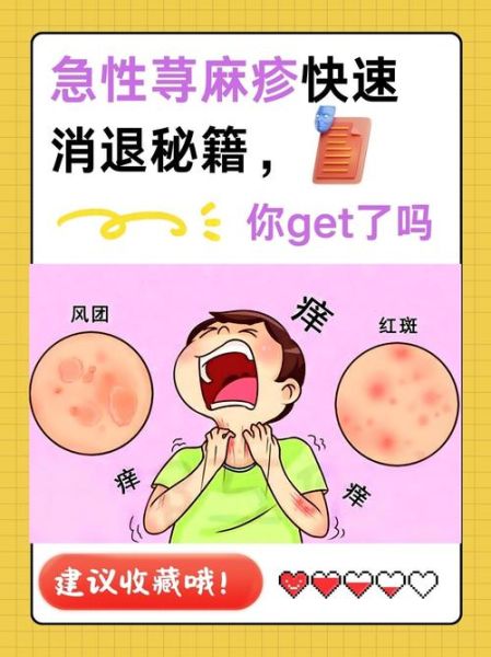 荨麻疹快速止痒小妙招_荨麻疹怎么止痒最快最有效-第2张图片-山城妙识 荨麻疹快速止痒小妙招_荨麻疹怎么止痒最快最有效-第2张图片-山城妙识