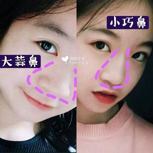 大蒜鼻怎么变小_大蒜鼻自然缩小的方法-第1张图片-山城妙识 大蒜鼻怎么变小_大蒜鼻自然缩小的方法-第1张图片-山城妙识