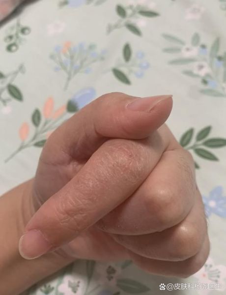 山药过敏症状图片_山药过敏怎么办-第2张图片-山城妙识