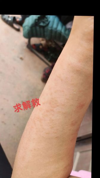 山药过敏症状图片_山药过敏怎么办-第3张图片-山城妙识