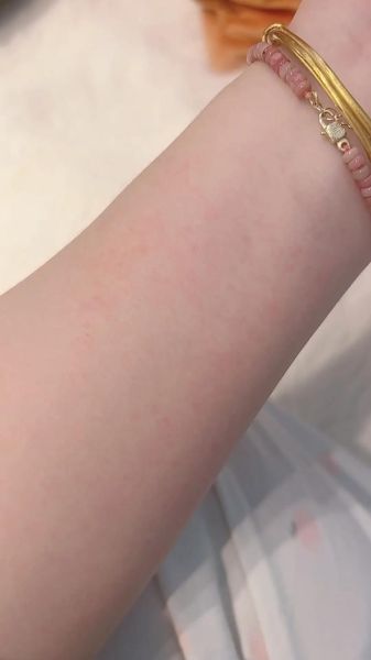 山药过敏症状图片_山药过敏怎么办-第1张图片-山城妙识