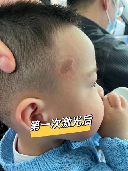 牛奶咖啡斑图片小孩_会自己消失吗-第3张图片-山城妙识 牛奶咖啡斑图片小孩_会自己消失吗-第3张图片-山城妙识