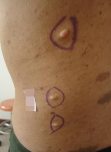 牛奶咖啡斑图片小孩_会自己消失吗-第2张图片-山城妙识 牛奶咖啡斑图片小孩_会自己消失吗-第2张图片-山城妙识