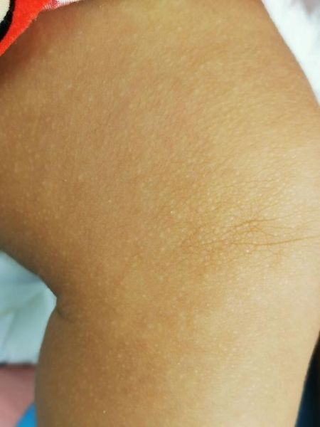 鸡皮疙瘩图片_为什么会起鸡皮疙瘩-第2张图片-山城妙识 鸡皮疙瘩图片_为什么会起鸡皮疙瘩-第2张图片-山城妙识