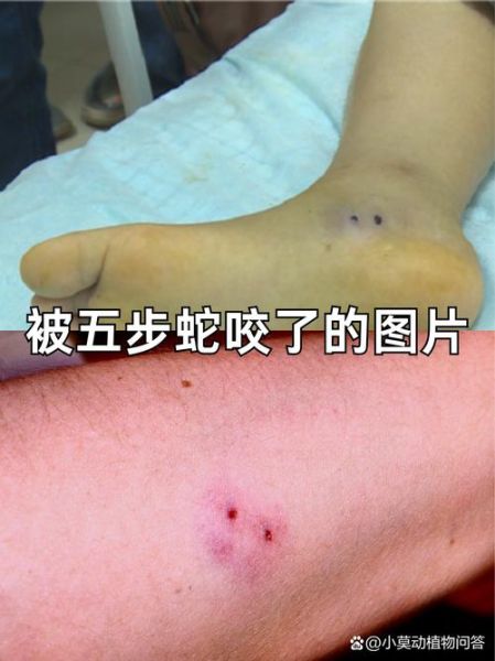 五步蛇咬伤怎么处理_被五步蛇咬了多久有反应-第1张图片-山城妙识