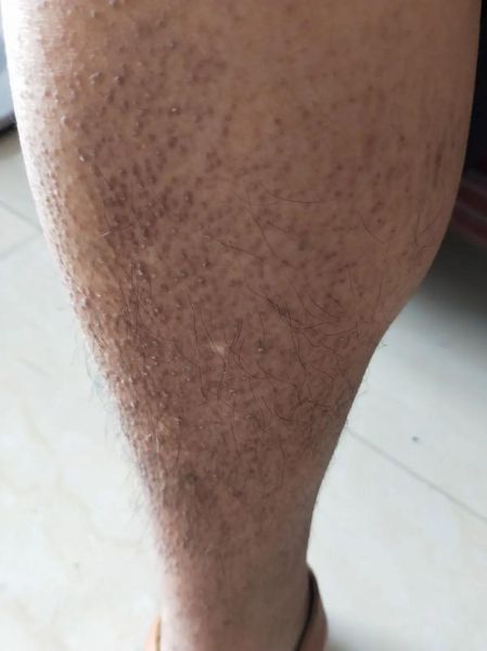 淀粉样变皮肤病怎么治疗_能根治吗-第1张图片-山城妙识