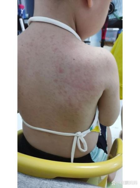 蚕豆过敏症状_蚕豆病不能吃蚕豆吗-第1张图片-山城妙识