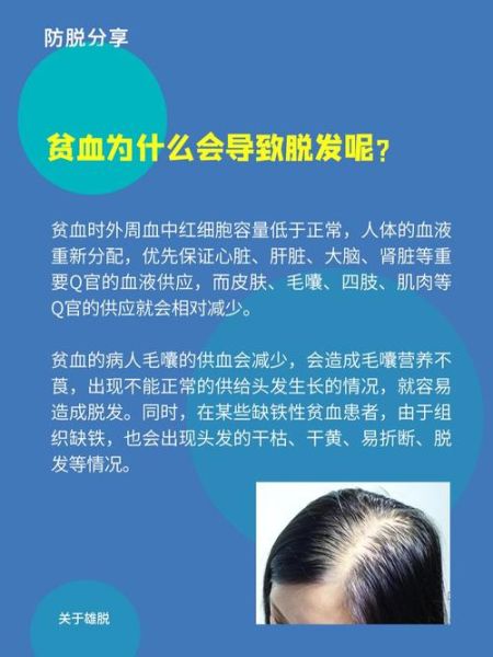贫血会导致脱发吗_贫血脱发怎么办-第2张图片-山城妙识