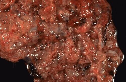 葡萄胎图片_如何识别葡萄胎早期症状-第2张图片-山城妙识