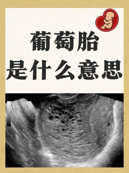 葡萄胎图片_如何识别葡萄胎早期症状-第1张图片-山城妙识