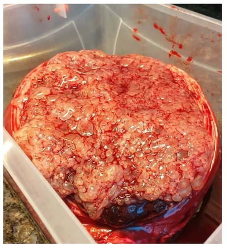 葡萄胎图片_如何识别葡萄胎早期症状-第3张图片-山城妙识