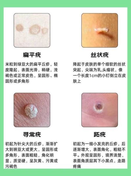 疣体初期症状图片_如何区分12种疣体类型-第1张图片-山城妙识 疣体初期症状图片_如何区分12种疣体类型-第1张图片-山城妙识
