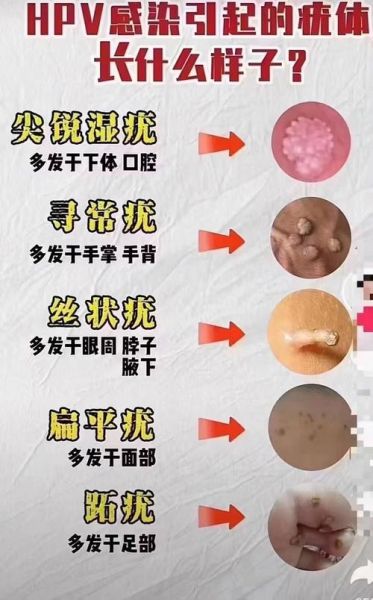 疣体初期症状图片_如何区分12种疣体类型-第2张图片-山城妙识 疣体初期症状图片_如何区分12种疣体类型-第2张图片-山城妙识