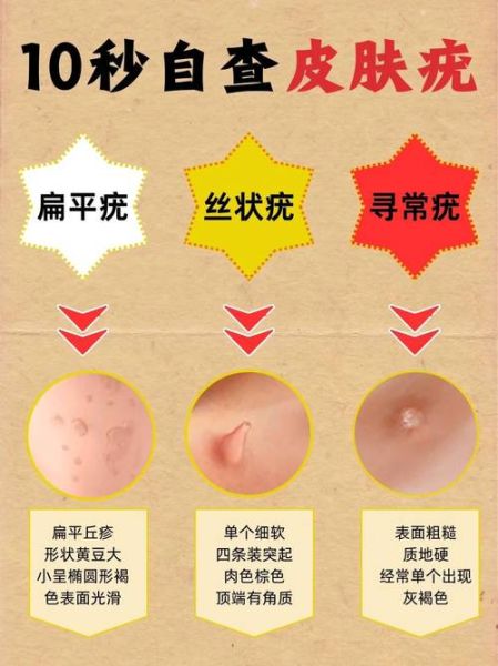 疣体初期症状图片_如何区分12种疣体类型-第3张图片-山城妙识 疣体初期症状图片_如何区分12种疣体类型-第3张图片-山城妙识