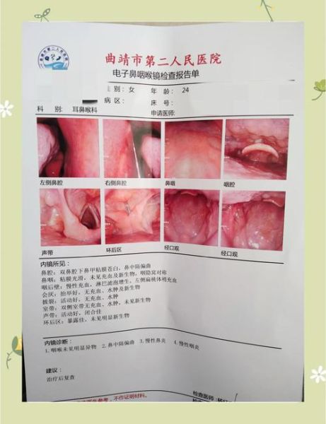做完咽喉镜后悔死了_咽喉镜副作用有哪些-第1张图片-山城妙识