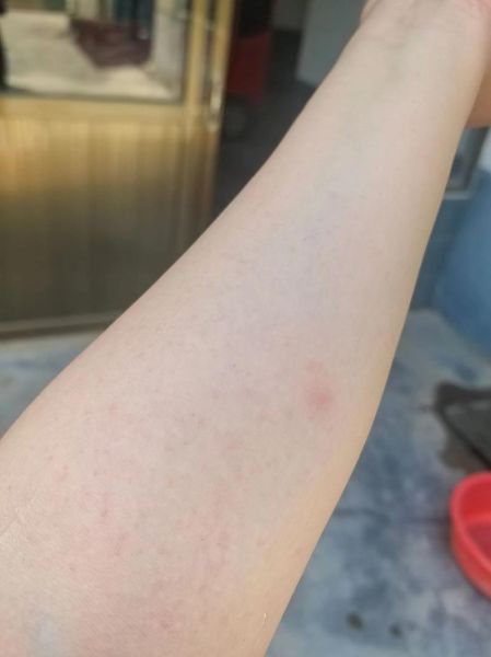 海鲜过敏快速止痒_海鲜过敏痒多久能好-第3张图片-山城妙识