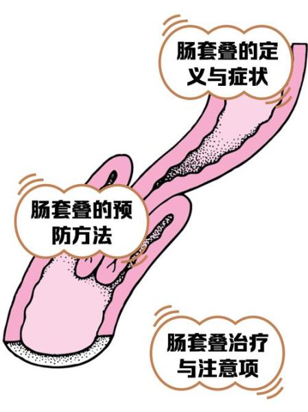 九转大肠套肠手法_怎么套才不断-第2张图片-山城妙识