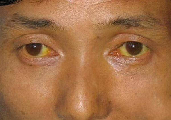 肝病脸上有什么症状_肝病面部图片对照-第2张图片-山城妙识