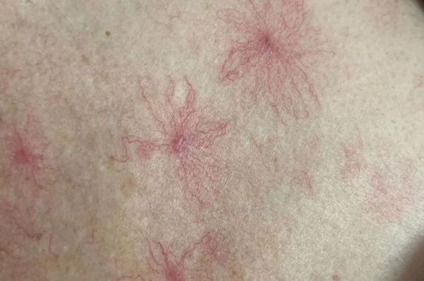 肝病脸上有什么症状_肝病面部图片对照-第1张图片-山城妙识