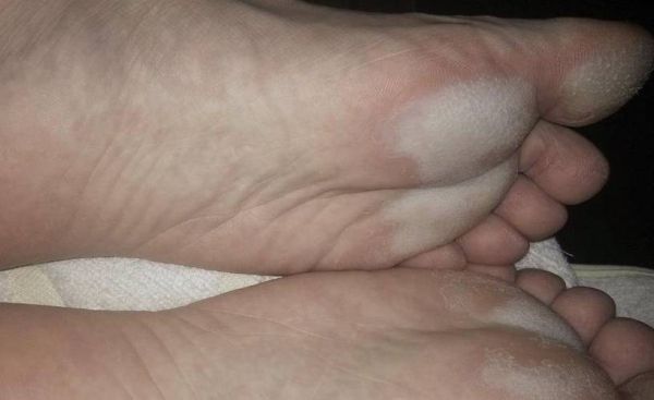 得了肝病脚先知道_肝病早期脚部信号有哪些-第2张图片-山城妙识