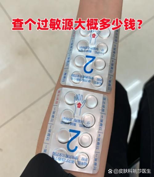 查过敏源多少钱一次_查过敏源价格影响因素-第2张图片-山城妙识