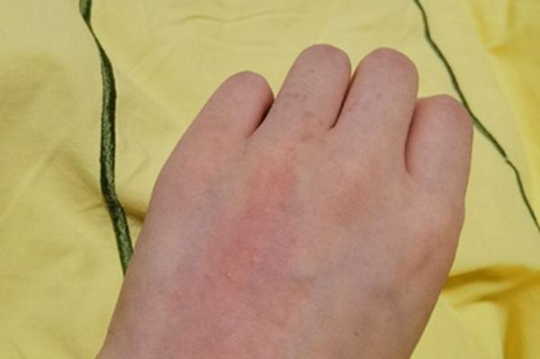 怎么判断自己海鲜过敏_海鲜过敏症状有哪些-第1张图片-山城妙识 怎么判断自己海鲜过敏_海鲜过敏症状有哪些-第1张图片-山城妙识