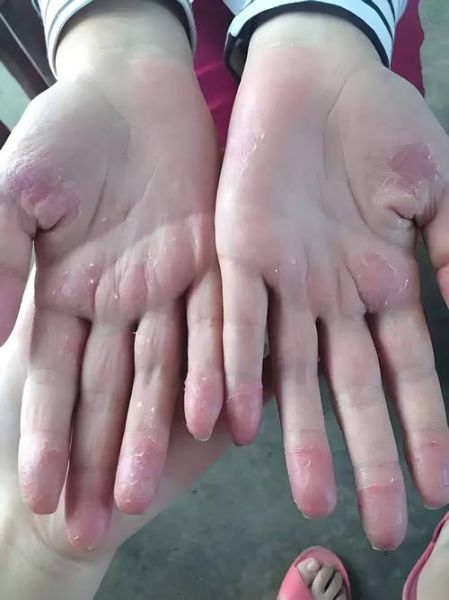 白果皮手脱皮怎么办_白果皮过敏症状-第2张图片-山城妙识 白果皮手脱皮怎么办_白果皮过敏症状-第2张图片-山城妙识