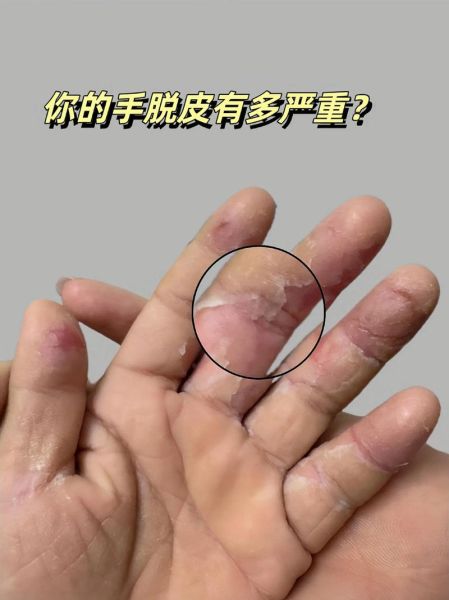 白果皮手脱皮怎么办_白果皮过敏症状-第3张图片-山城妙识 白果皮手脱皮怎么办_白果皮过敏症状-第3张图片-山城妙识