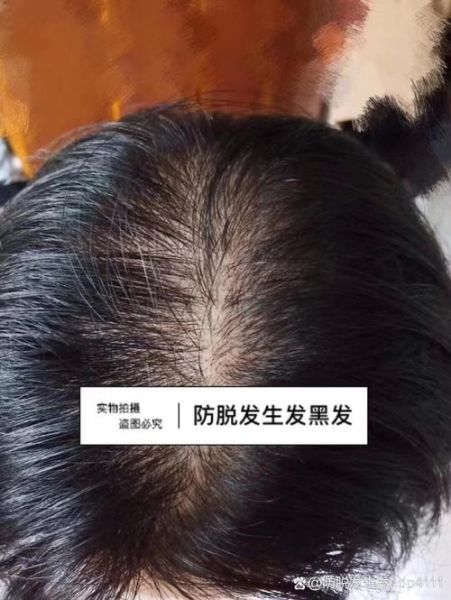 脂溢性脱发怎么恢复发量_脂溢性脱发多久能长回来-第1张图片-山城妙识