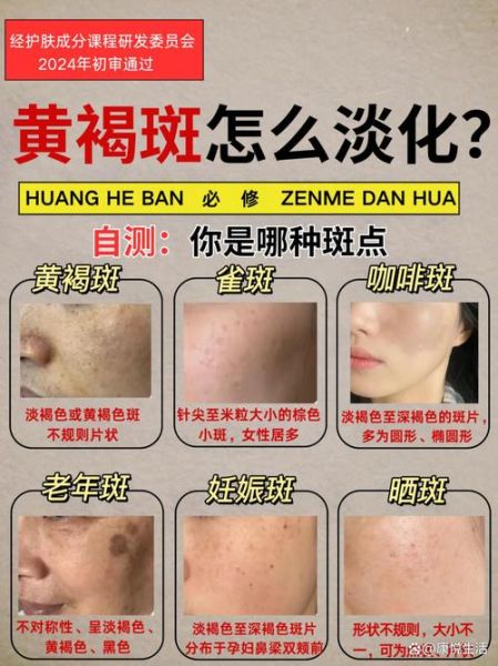 用什么可以祛斑_祛斑最有效的方法是什么-第2张图片-山城妙识