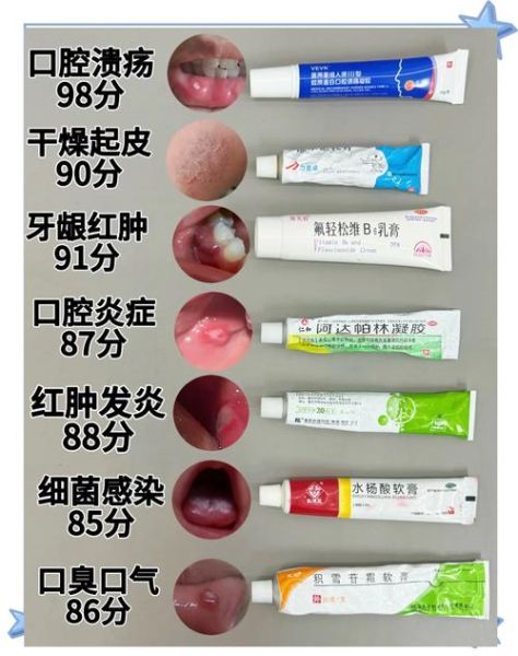 口腔溃疡吃什么药好使_口腔溃疡多久能好-第1张图片-山城妙识 口腔溃疡吃什么药好使_口腔溃疡多久能好-第1张图片-山城妙识