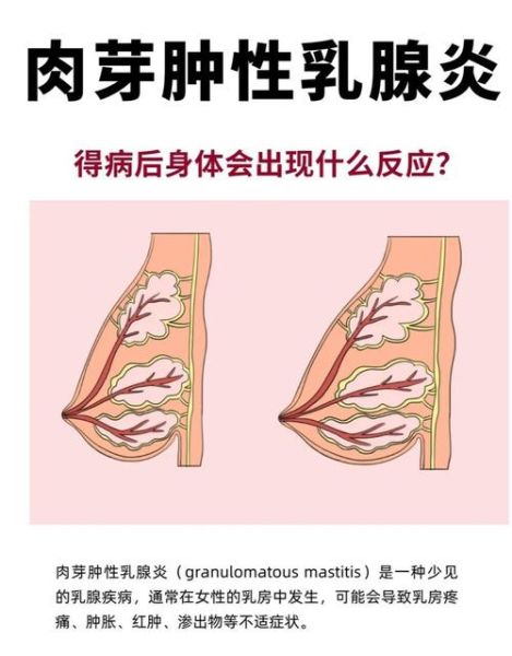 乳腺增生症状图片_乳腺增生有哪些典型表现-第3张图片-山城妙识