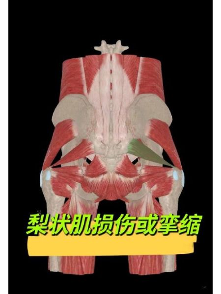 梨状肌综合症是什么_梨状肌综合症怎么治-第2张图片-山城妙识