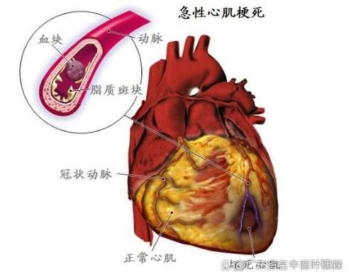 心肌缺血能活多久_心肌缺血活不过十年是真的吗-第1张图片-山城妙识 心肌缺血能活多久_心肌缺血活不过十年是真的吗-第1张图片-山城妙识