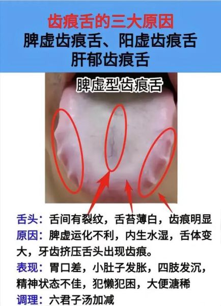 齿痕舌是脾气虚还是脾阳虚_如何区分与调理-第2张图片-山城妙识