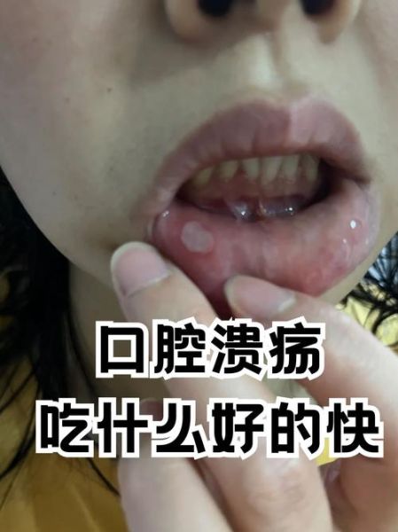 嘴巴长溃疡怎么快速好_嘴巴溃疡吃什么好得快-第3张图片-山城妙识