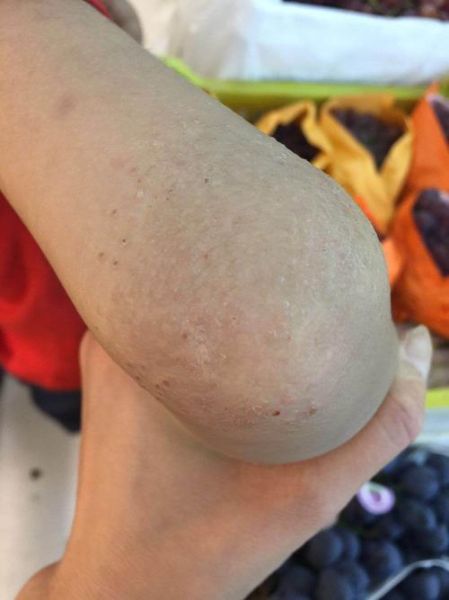 吃螃蟹过敏的症状_多久能好-第3张图片-山城妙识 吃螃蟹过敏的症状_多久能好-第3张图片-山城妙识