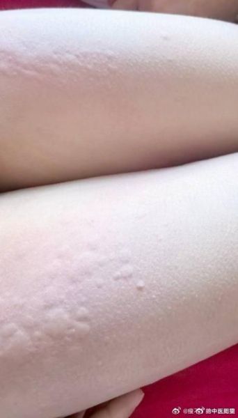 吃螃蟹过敏的症状_多久能好-第2张图片-山城妙识 吃螃蟹过敏的症状_多久能好-第2张图片-山城妙识