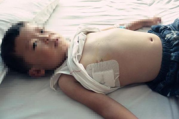 鸡胸病图片_鸡胸病怎么治疗-第3张图片-山城妙识