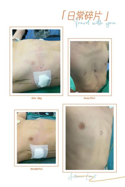 鸡胸病图片_鸡胸病怎么治疗-第2张图片-山城妙识