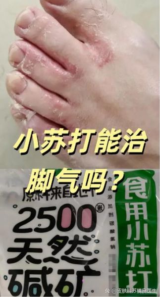 小苏打治脚气有效吗_小苏打治脚气的正确用法-第1张图片-山城妙识 小苏打治脚气有效吗_小苏打治脚气的正确用法-第1张图片-山城妙识