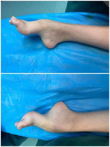 马蹄足能治好吗_马蹄足手术费用多少钱-第2张图片-山城妙识