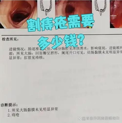 痔疮怎么治_痔疮手术多少钱-第2张图片-山城妙识 痔疮怎么治_痔疮手术多少钱-第2张图片-山城妙识