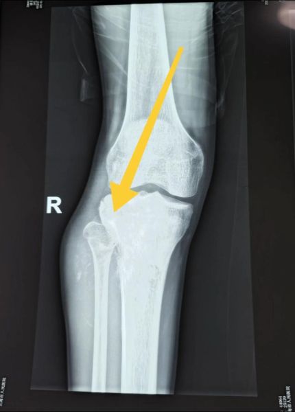 骨肉瘤图片怎么看_早期症状识别-第1张图片-山城妙识 骨肉瘤图片怎么看_早期症状识别-第1张图片-山城妙识