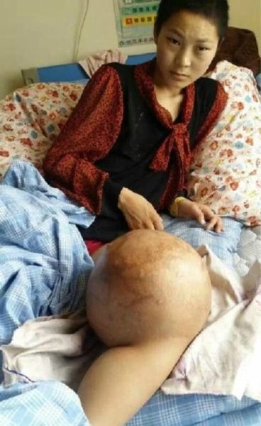 骨肉瘤图片怎么看_早期症状识别-第2张图片-山城妙识 骨肉瘤图片怎么看_早期症状识别-第2张图片-山城妙识