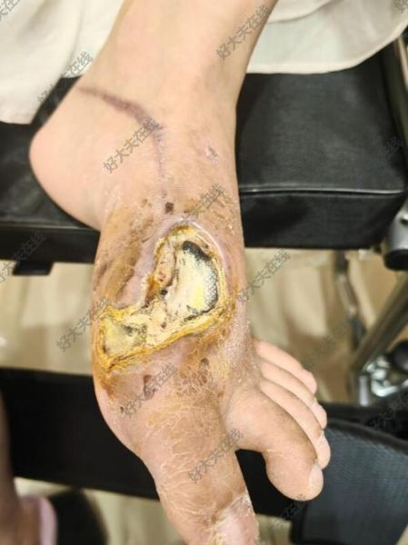 骨肉瘤图片怎么看_早期症状识别-第3张图片-山城妙识 骨肉瘤图片怎么看_早期症状识别-第3张图片-山城妙识