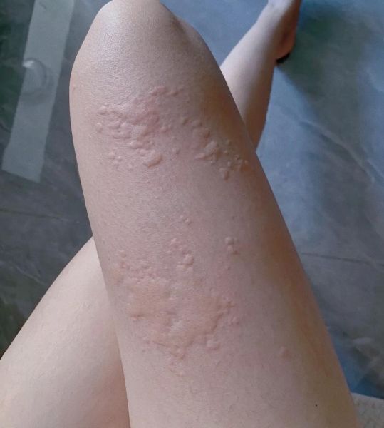 荨麻疹不管它会自愈吗_荨麻疹不治疗多久能好-第3张图片-山城妙识 荨麻疹不管它会自愈吗_荨麻疹不治疗多久能好-第3张图片-山城妙识