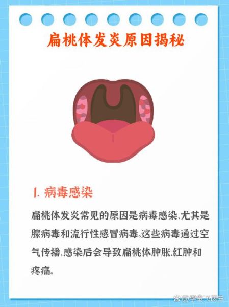 扁桃体发炎一般几天好_扁桃体发炎多久能好-第1张图片-山城妙识