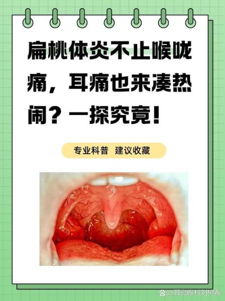 扁桃体发炎一般几天好_扁桃体发炎多久能好-第3张图片-山城妙识